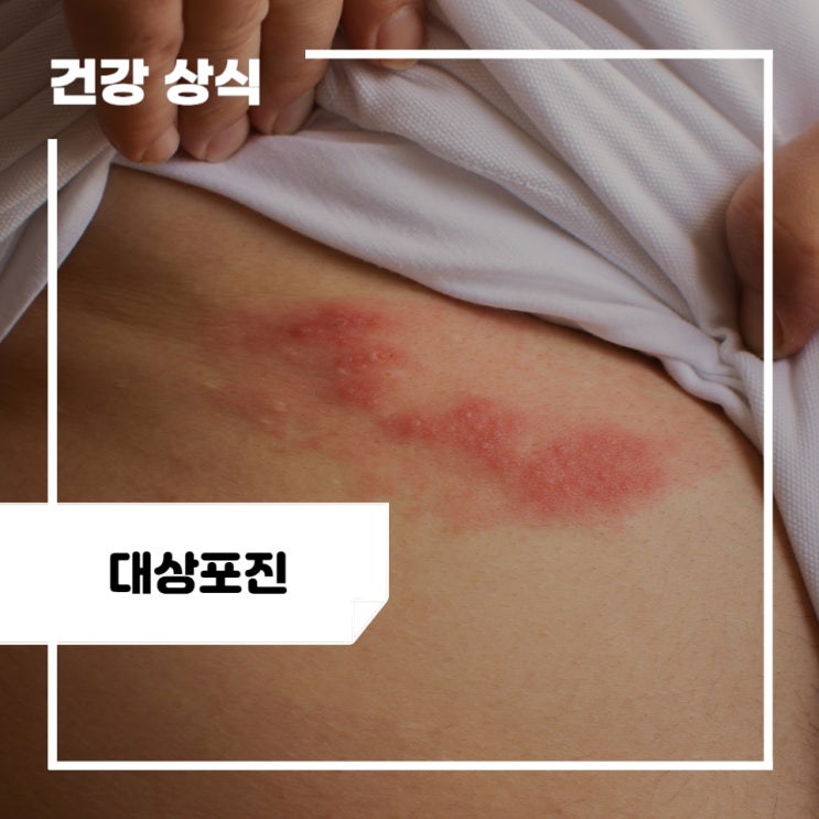 대상포진 전조 및 초기 증상 및 원인 검사 치료 방법 감염 전염성 증세 위치 손가락 허리 허벅지 얼굴 네이버 블로그
