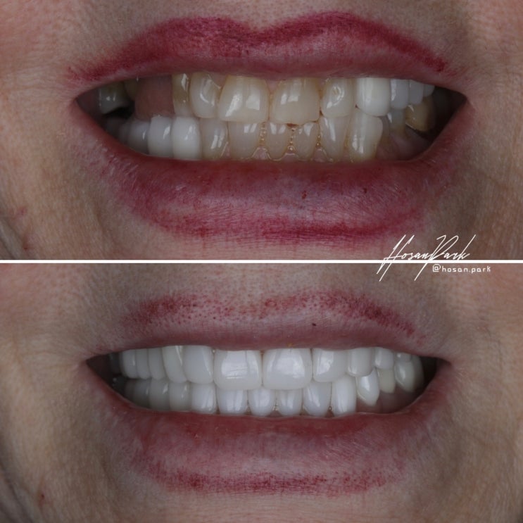 압구정 시니어 라미네이트, 나이는 문제가 되지 않습니다 : 네이버 블로그