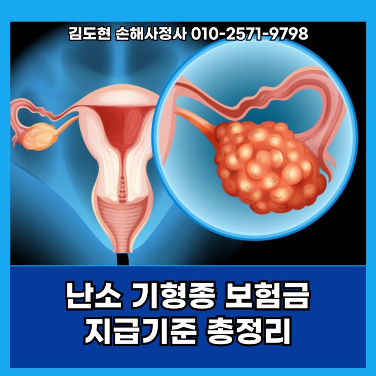 난소의 기형종 종류와 보험금 지급 기준 총정리 성숙 기형종 Vs 미성숙 기형종 네이버 블로그