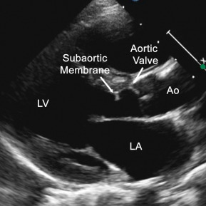 🫀Subaortic membrane (discrete subarotic stenosis) echo finding : 네이버 블로그