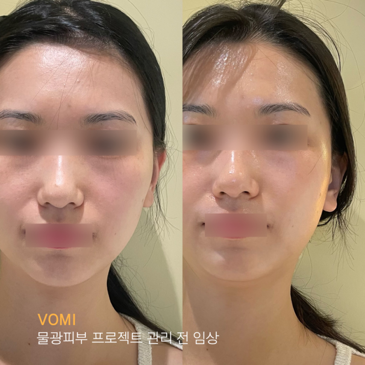 덕천피부관리 10월 이벤트 LDM물방울리프팅 : 네이버 블로그