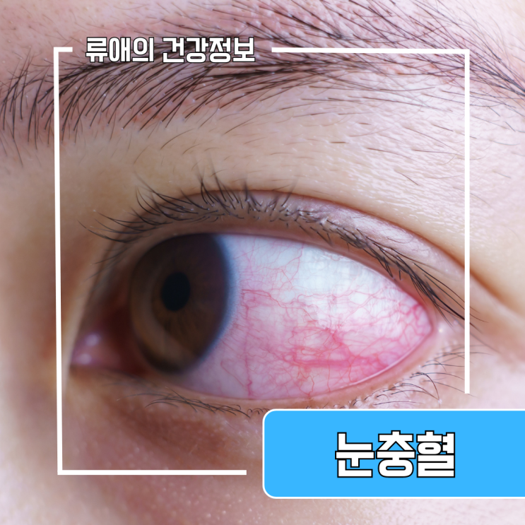 눈충혈됐을때 양쪽 눈충혈 원인 안약 정보 네이버 블로그