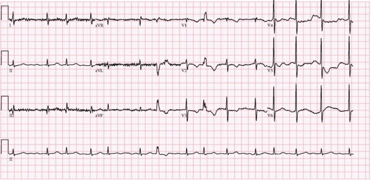심방세동과 심방조동(atrial fibrillation & atrial flutter) : 네이버 블로그