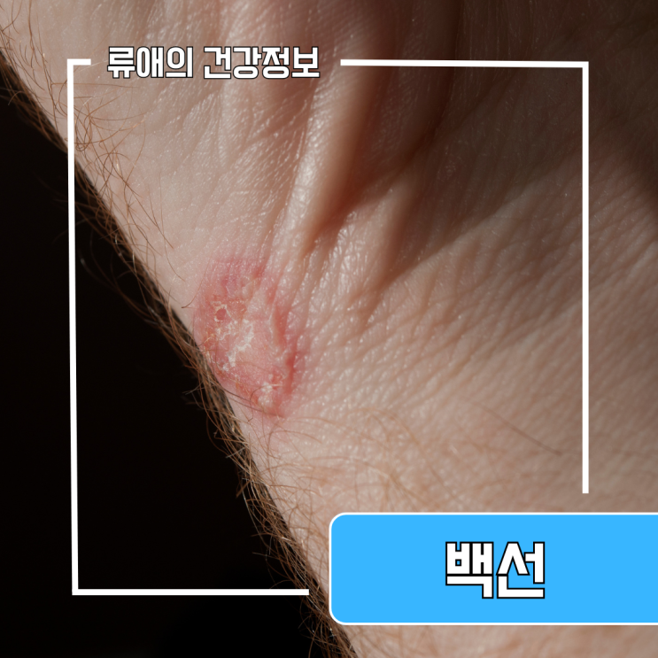 피부 백선 증상 원인 치료 사타구니 두피 얼굴 네이버 블로그