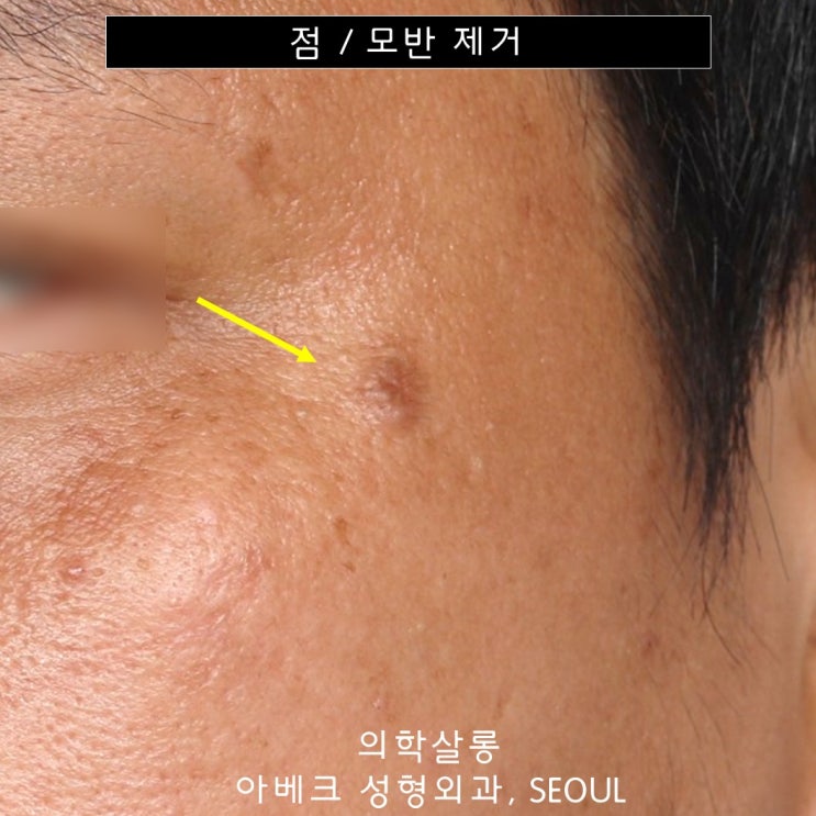 얼굴의 큰 점 제거 수술 모반절제술 수술 흉터 【dr 아베크 점모반】 네이버 블로그