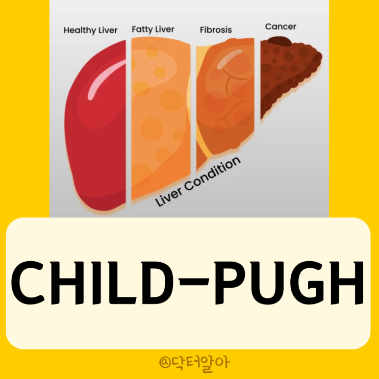 Child-Pugh Score(CTP score)의 정의, 구성 요소, 해석, 한계 : 네이버 블로그