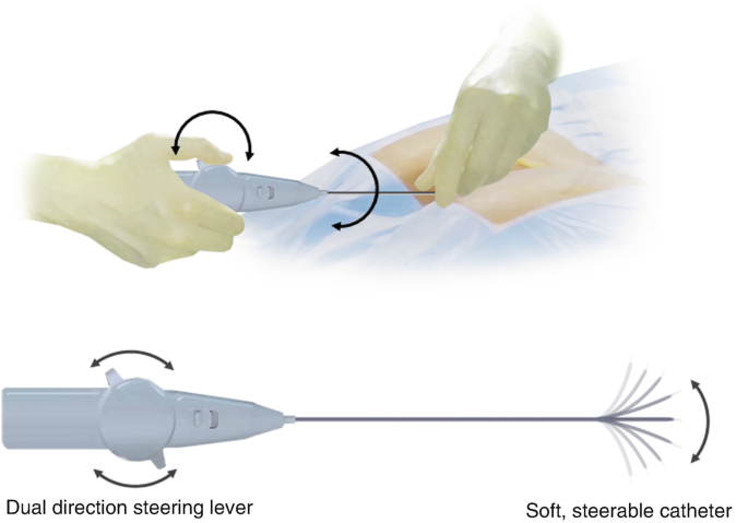허리 신경성형술 (L-PEN, PEN, Percutaneous Epidural Neuroplasty) 이론 및 술기 [경피적 ...
