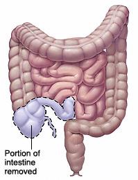 회맹부 절제술(ileocecectomy) : 네이버 블로그
