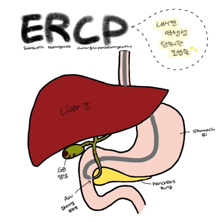 외과 PA) ERCP 내시경역행담췌관조영술(Endoscopic retrograde choangiopancreatography ...