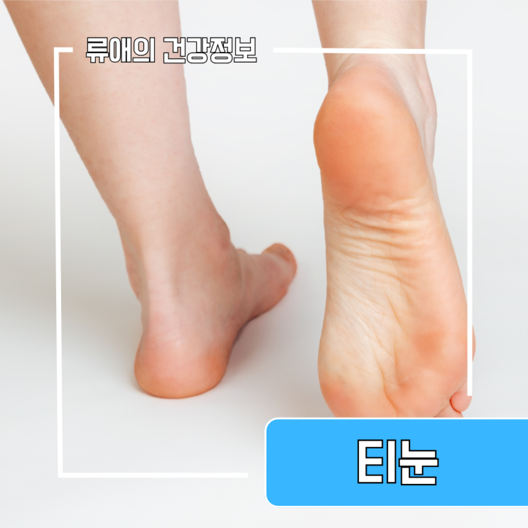발바닥 티눈 원인 치료 약 밴드 발바닥 티눈 제거 레이저 네이버 블로그