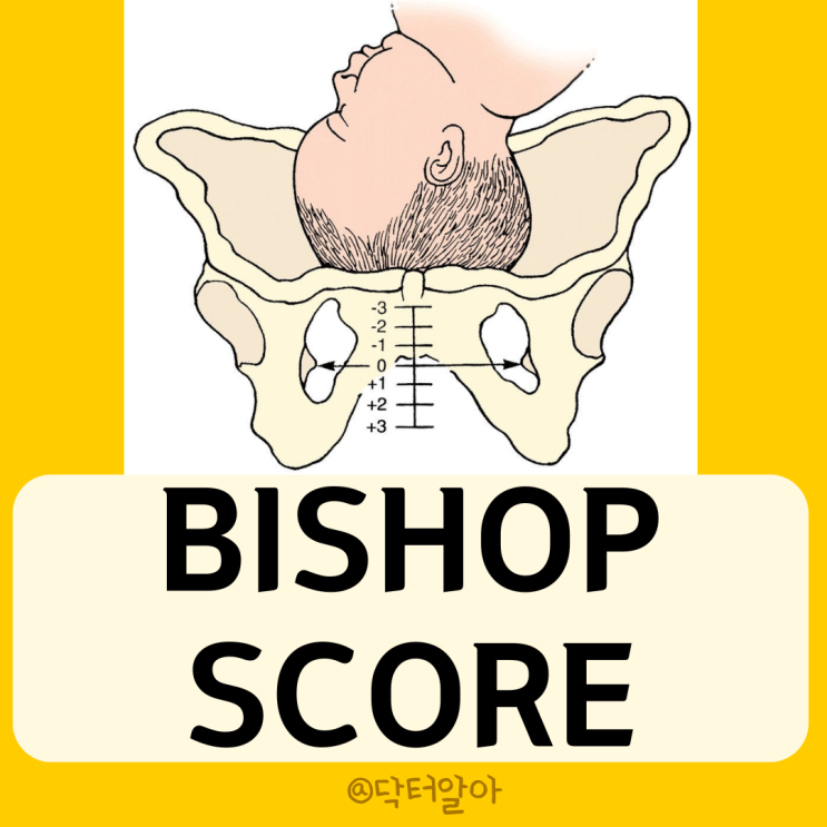 Bishop score (비숍 점수)의 정의, 구성, 해석, 활용, 한계 : 네이버 블로그