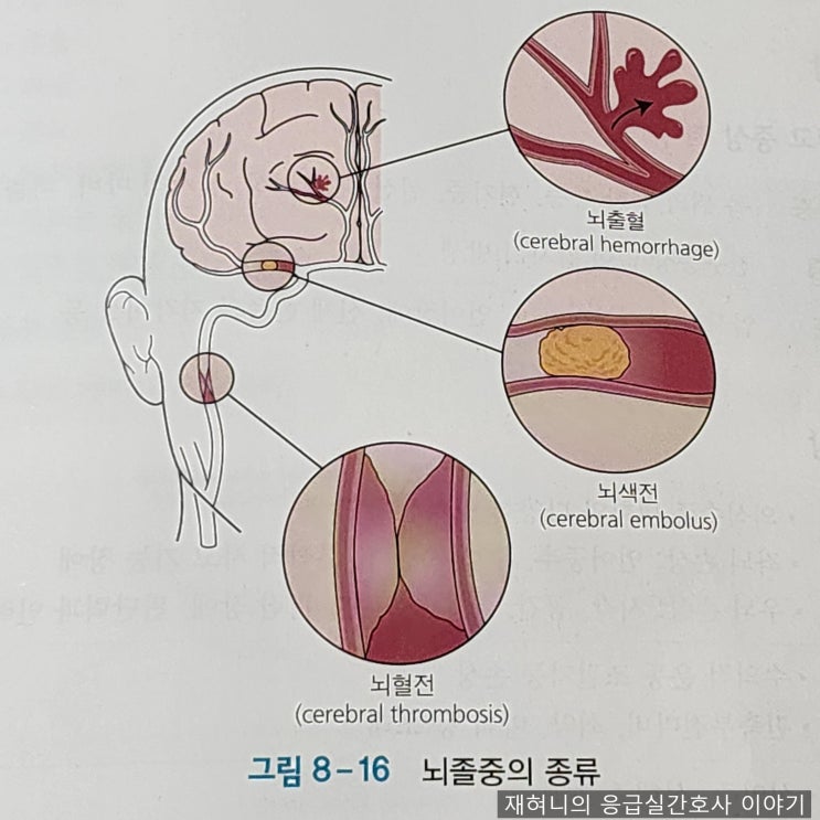 뇌졸중 전조증상과 의학용어 ICH SDH SAH의 CT 비교 : 네이버 블로그
