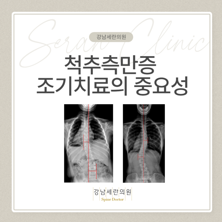 척추측만증 척추옆굽은증은 조기치료 하지 않으면 교정 치료의 중요성 네이버 블로그