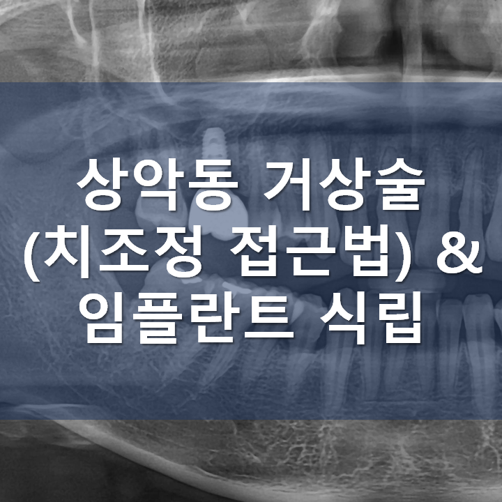 오남리 치과 상악동 거상술치조정 접근법과 임플란트 식립 네이버 블로그
