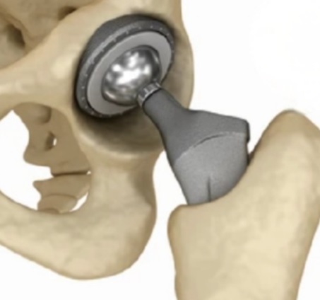 [정형외과] THRA(Total hip replacement arthroplasty, THRA) vs BHA(Bipolar ...