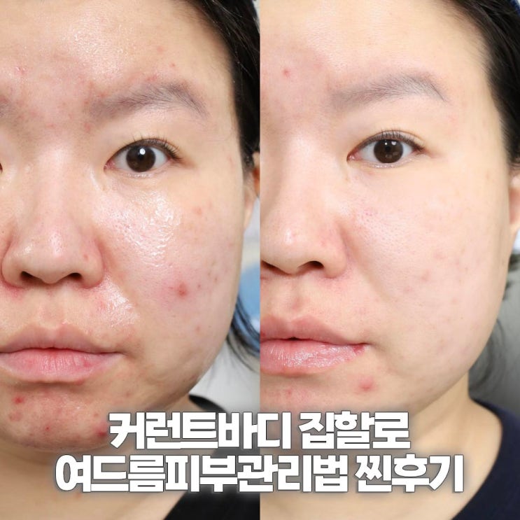 커런트바디 뷰티디바이스 집할로 실버젤 사용 두달 변화 여드름피부관리법 네이버 블로그