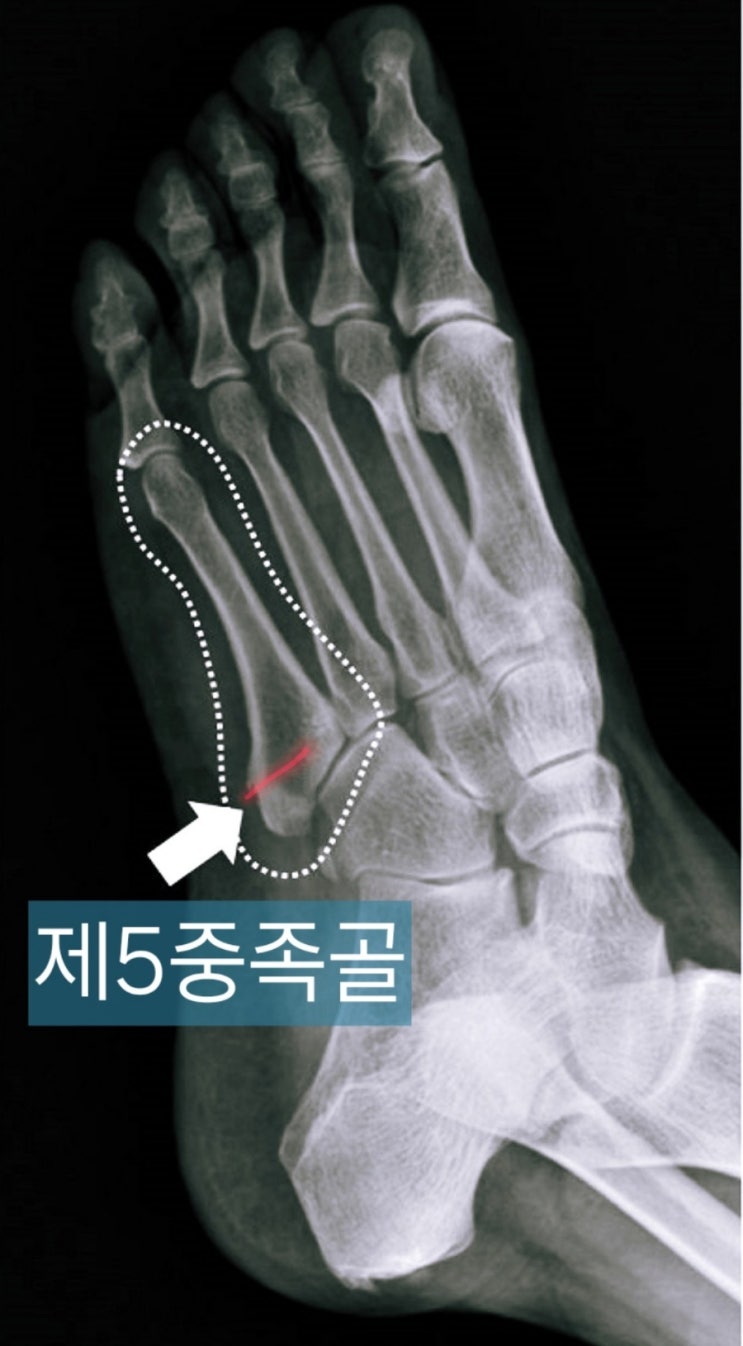 깁스일지 1주차 발등 골절 제5중족골 뼈에 금 갔을때 대처방법 깁스생활 필수템 네이버 블로그