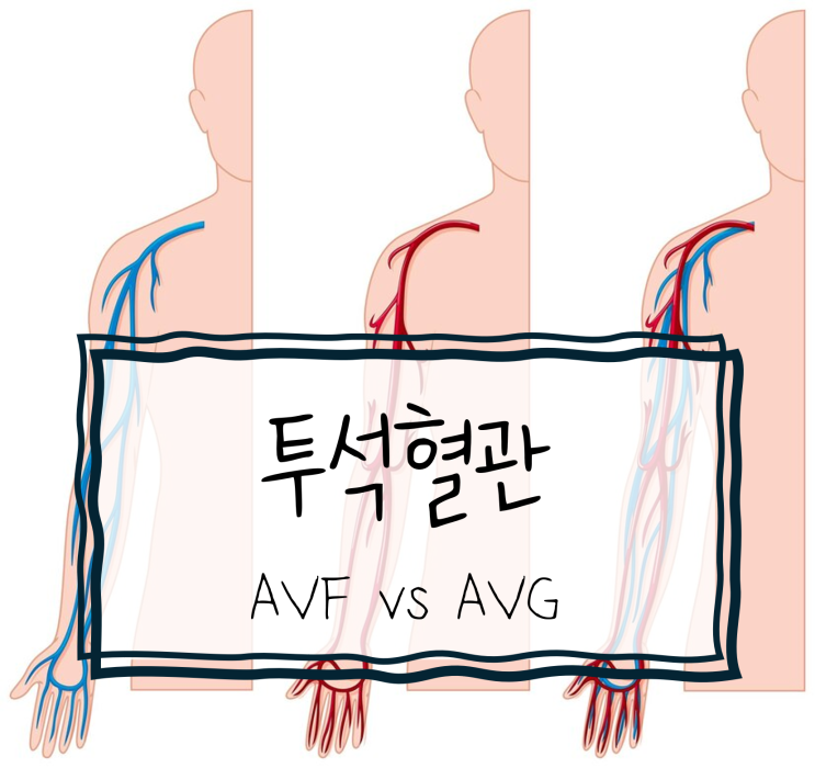 [OR] 투석혈관 조성술(AVF&AVG) : 네이버 블로그