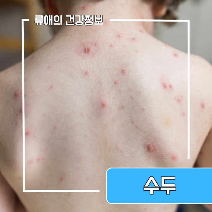 아기 수두초기증상 원인 전염 성인 초등 수두초기증상 치료 네이버 블로그