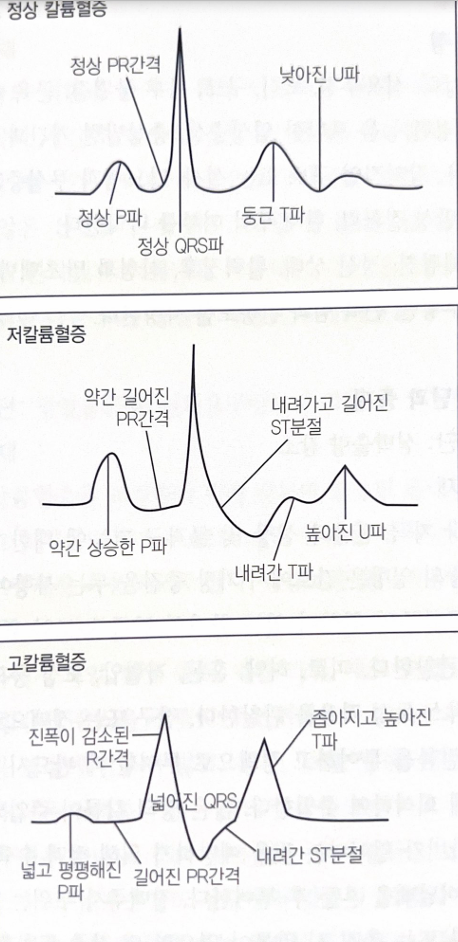 저칼륨혈증과 고칼륨혈증의 원인 증상과징후 간호 사용되는 약물 총정리 네이버 블로그