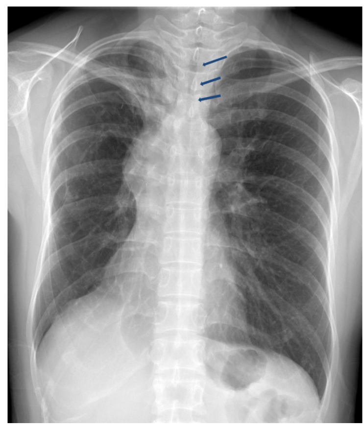 기관기관지결핵, tracheobronchial tuberculosis, 활동성 폐결핵, 무기폐, CT : 네이버 블로그
