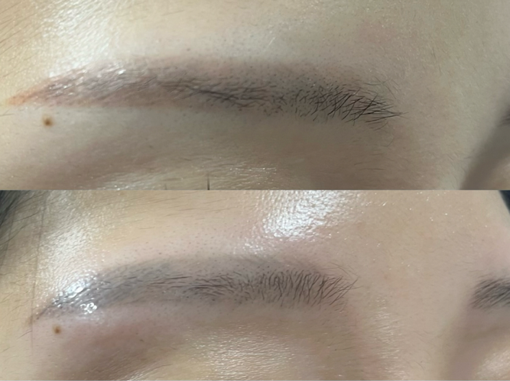 평택•오산•송탄 눈썹문신 잔흔 제거 1회차 내돈내산 후기 👀 붉은 기 제거가 되었을까요 🕯️ 송탄 ‘브로우 뮤트 모든 사진