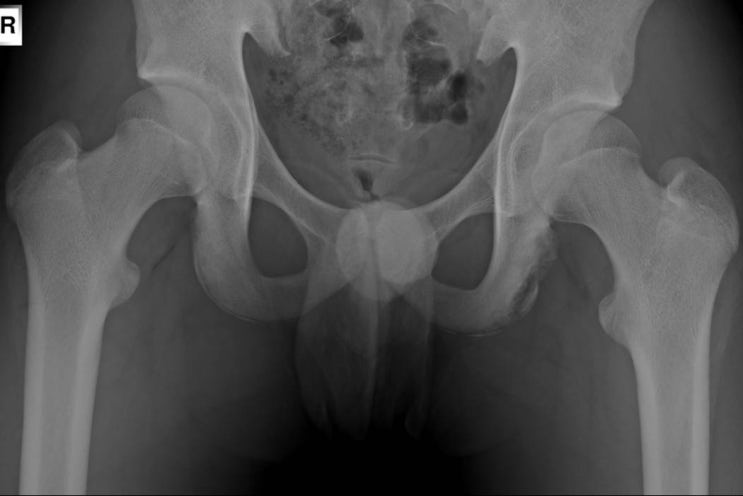 [골반][증례] ischial tuberosity Avulsion fracture or apophysitis (소아 성장판 견연 ...