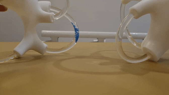 이석증 이석정복술 3편 - 이석치환술 Appiani (Gufoni) maneuver : 네이버 블로그