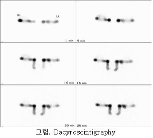 눈물길 검사 Dacryoscintigraphy, 알면 안심되는 핵의학 검사! : 네이버 블로그