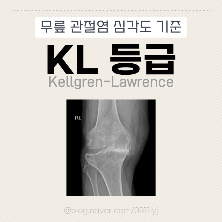 무릎 관절염 심각도 기준 KL Grade (Kellgren-Lawrence) : 네이버 블로그