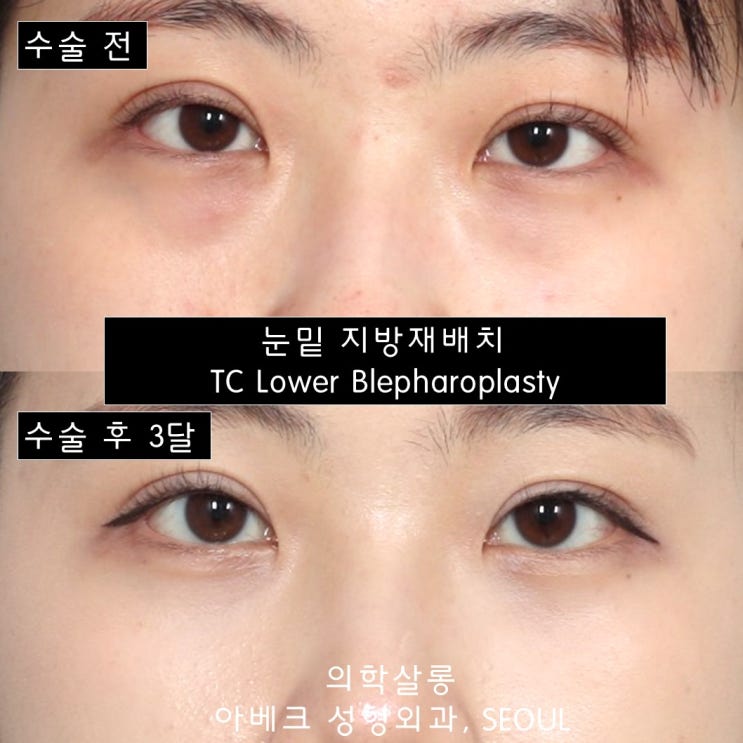 어두침침한 다크써클 눈밑지방재배치 수술 후기 【dr 아베크 눈성형】 네이버 블로그