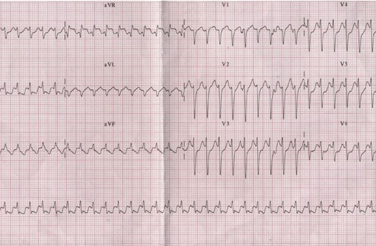 발작성 심실상 빈맥 (PSVT, Supraventricular Tachycardia, SVT) : 네이버 블로그