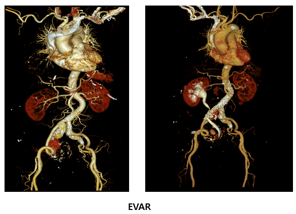 EVAR(Endovascular Aneurysm Repair) 적응증, 시술 전후 간호 : 네이버 블로그