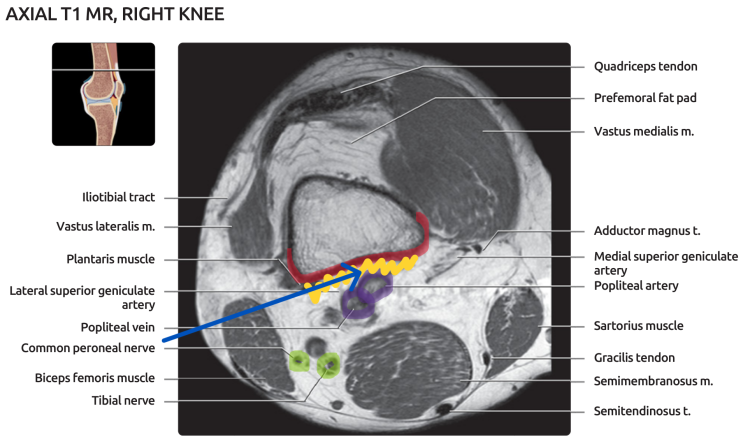 노원역 정형외과 무릎 통증, 오금 통증에 효과적인 아이팩(iPACK block) 주사. 수술한 무릎이 아프다면 : 네이버 블로그