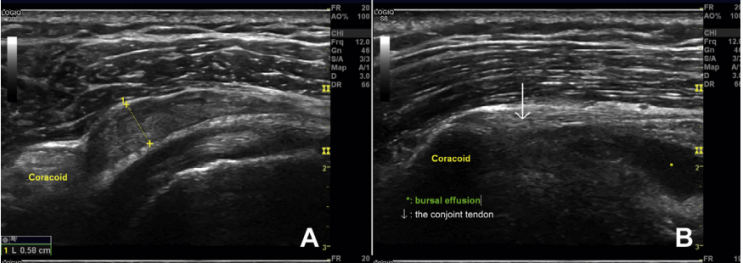 SASD bursa와 Subcoracoid bursa : 네이버 블로그