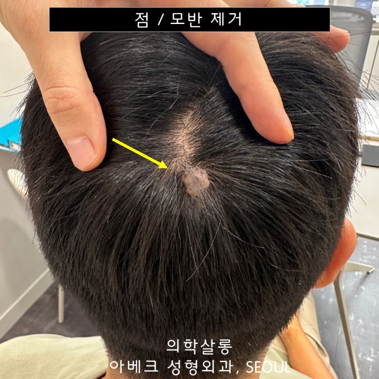 두피 튀어나온 점 모반 제거수술 후기 【dr 아베크 점모반】 네이버 블로그