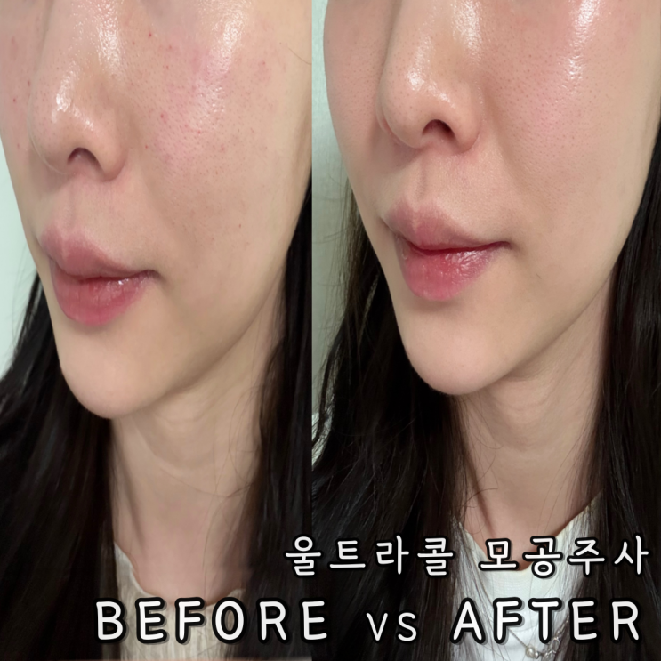 선릉역피부과 울트라콜100 모공주사 2CC 리얼후기 : 네이버 블로그