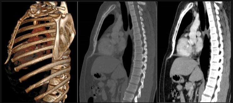 명치 혹 (hook-like xiphoid process) : 네이버 블로그