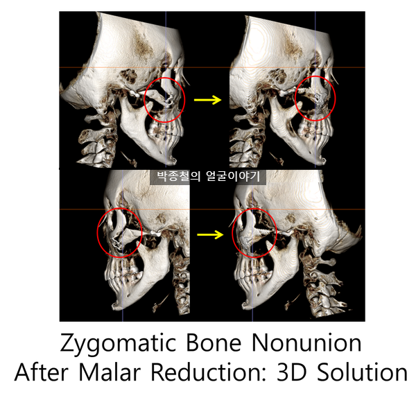 Zygomatic Bone Nonunion After Malar Reduction: A Case Study and 3D ...