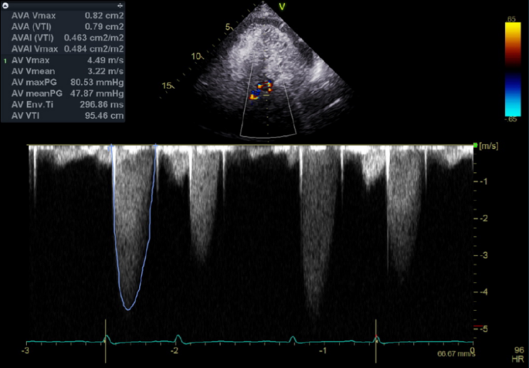 Infective endocarditis involving bioprosthetic stented AV : 네이버 블로그