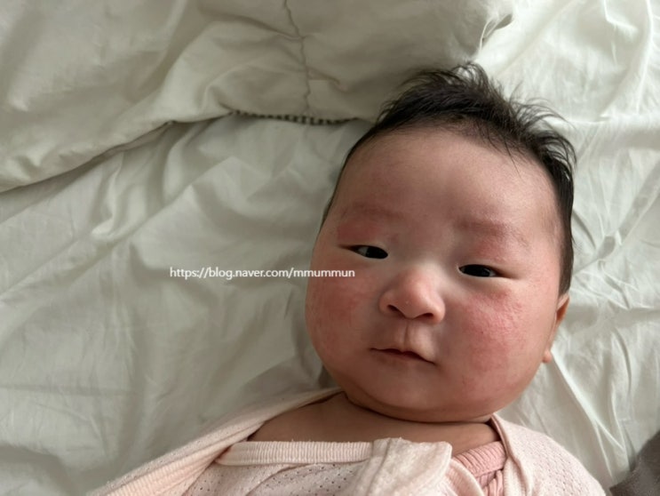 아기 영유아 아토피 치료 일기 초기 증상 아산병원 소아 호흡기 알레르기 센터 첫 방문 네이버 블로그