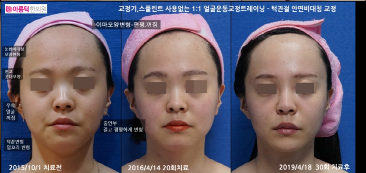 안면비대칭 교정은 곧 중안부 교정이며, 좌우비대칭만 개선되는 것이 아닌 안면윤곽, 비율, 특히 높낮이 차이가 개선되는게 ...