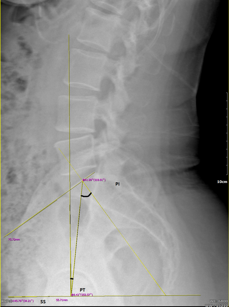 PI (Pelvic Incidence) = SS (Sacral Slope) + PT (Pelvic Tilt) 정의와 설명 ...
