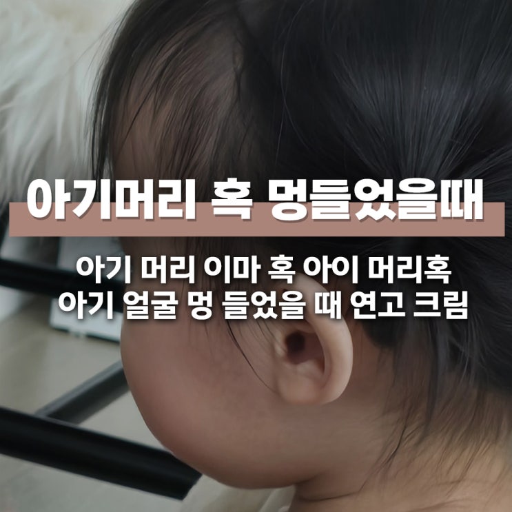 아기 머리 이마 혹 아이 머리혹 아기 얼굴 멍 들었을 때 연고 크림 네이버 블로그