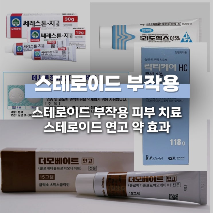 스테로이드 부작용 피부 치료 스테로이드 연고 약 효과 네이버 블로그