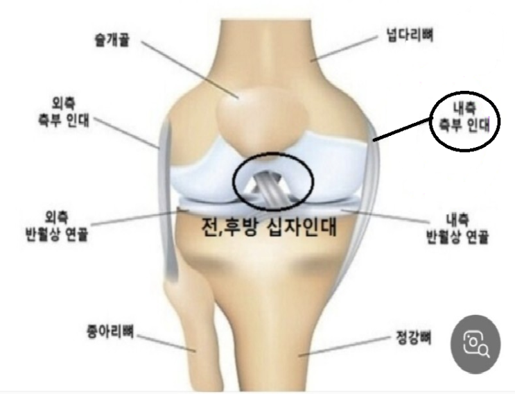 무릎 내측 측부인대 파열 무릎 통증 수술 없이 치료하기 사당역 헬스장 네이버 블로그