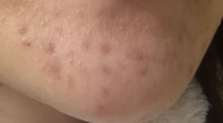 닥터글란츠 트러블세럼 3일 사용후기 내돈내산 : 네이버 블로그