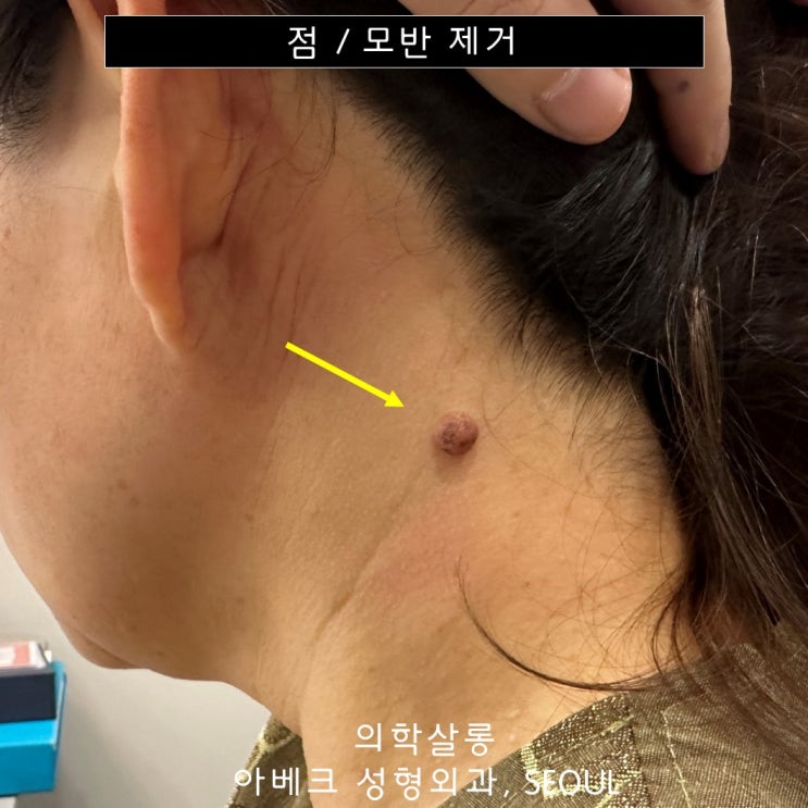 목에 생긴 커다란 점 모반 제거 수술 후기 【dr 아베크 점모반】 네이버 블로그