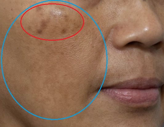 기미vs오타모반모양반점,애브넘,애브놈(ABNOM) 원인,차이,비교,치료 피부과전문의 완벽정리 : 네이버 블로그