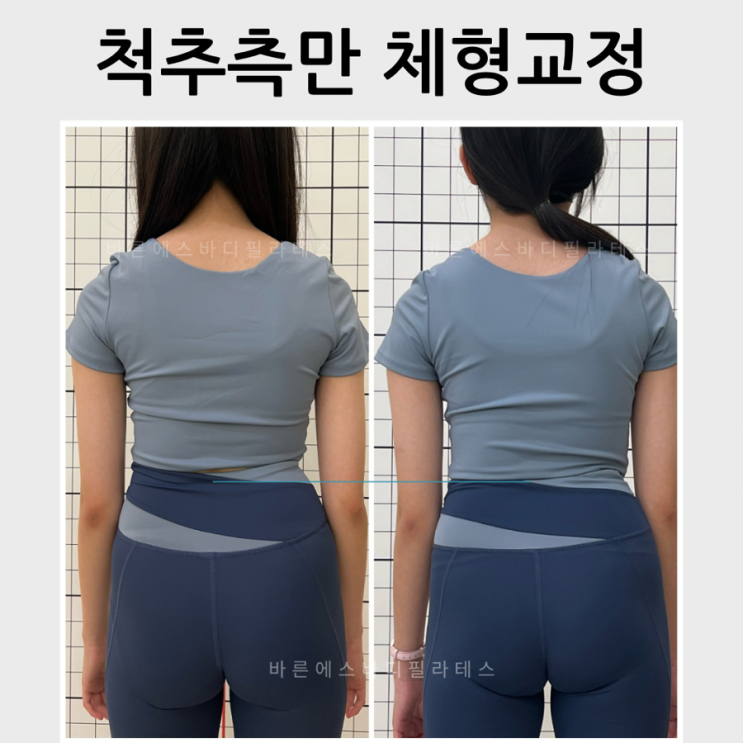 마산척추측만증필라테스 척추굽음증증 체형교정 특화운동 청소년 할인 네이버 블로그